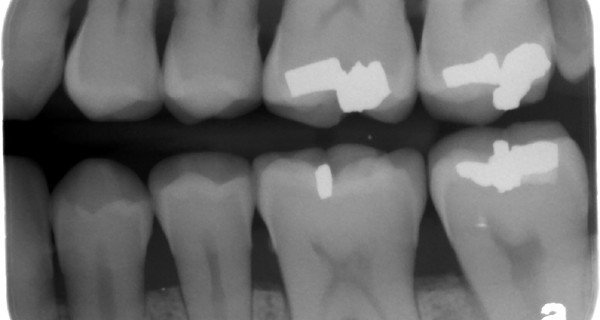 Bitewing | ORAL RX, Diagnóstico Radiológico, Radiografías Intraorales ...
